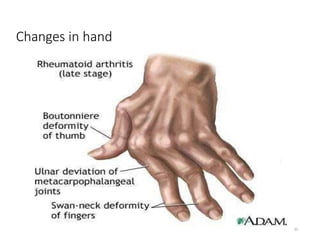 Rheumatoid Arthritis, Osteoarthritis-1.pptx