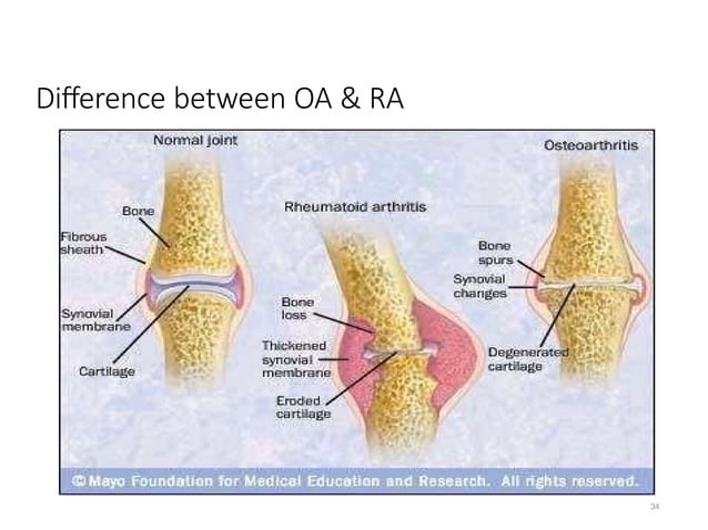 Rheumatoid Arthritis, Osteoarthritis-1.pptx