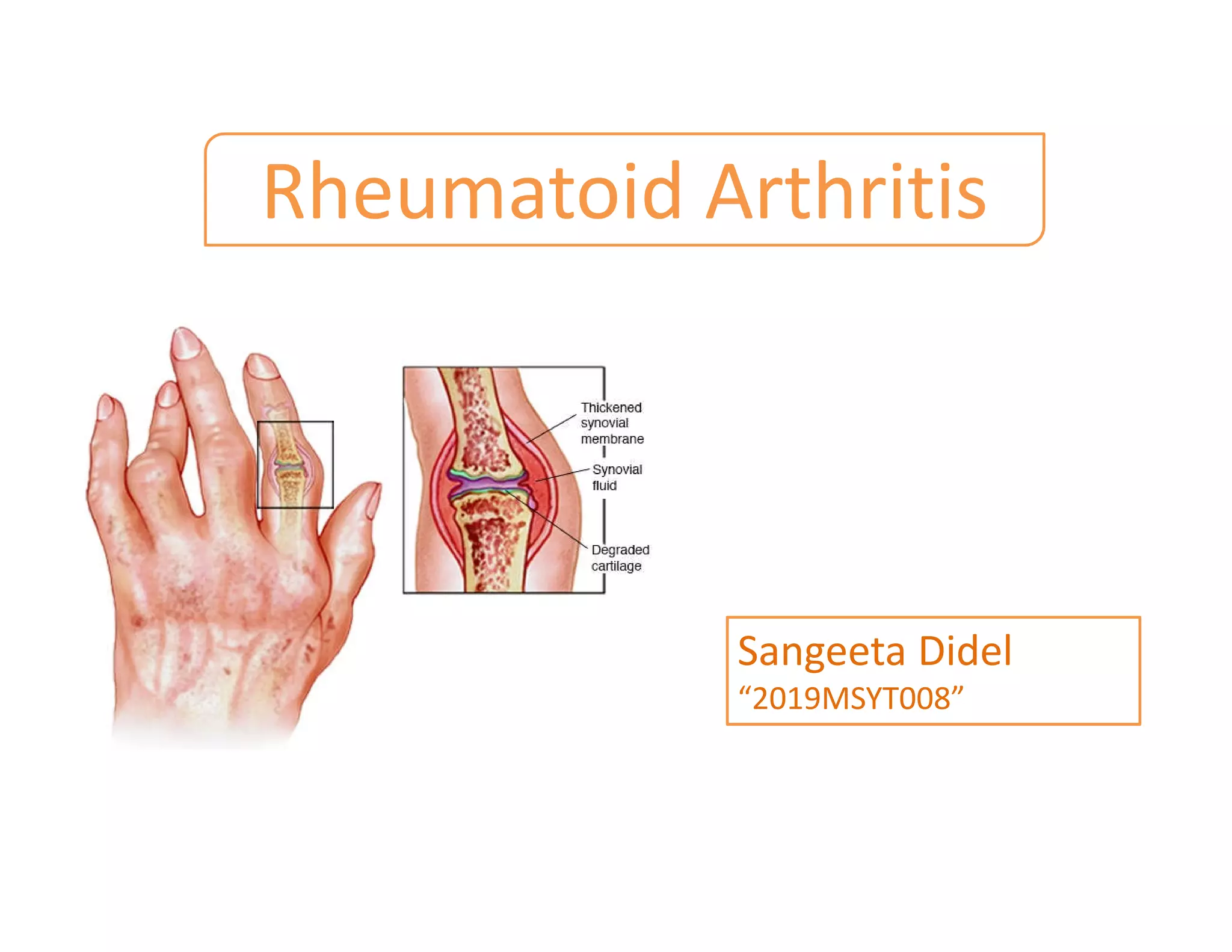 Rheumatoid arthritis pdf | PDF