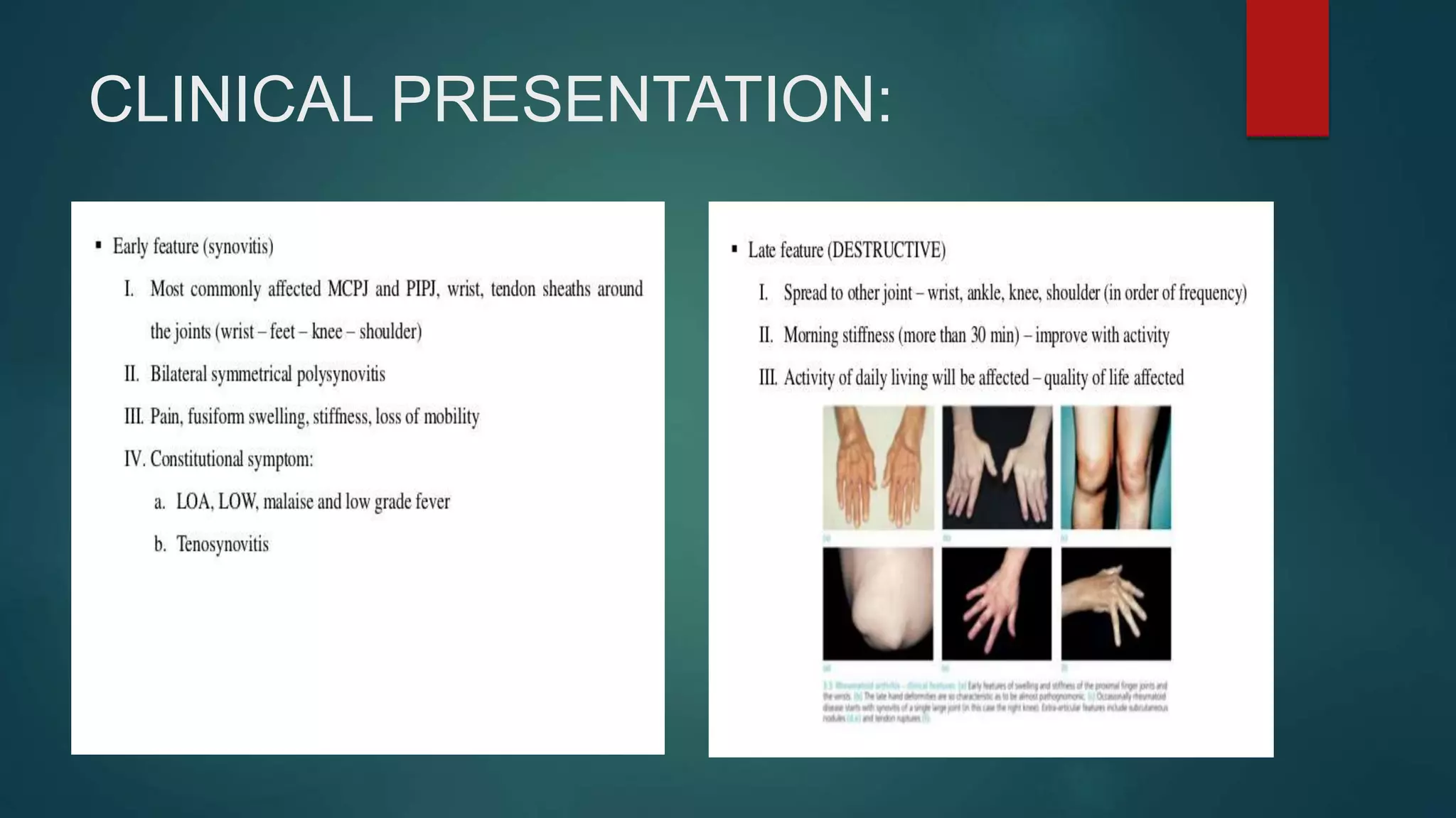 Rheumatoid arthritis ppt By Shaista Sumayya | PPT