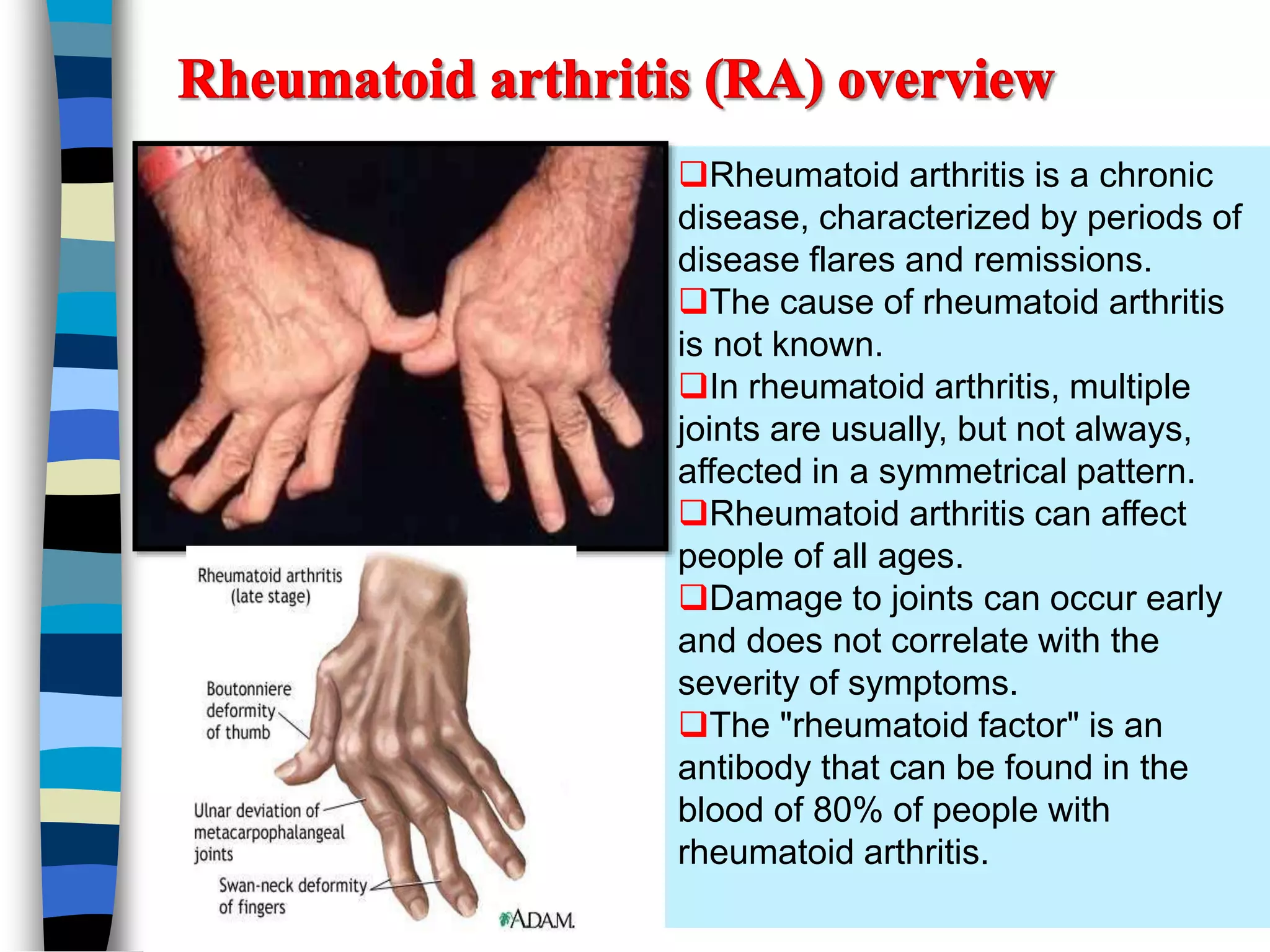 Rheumatoid arthritis ppt by ann.. | PPTX