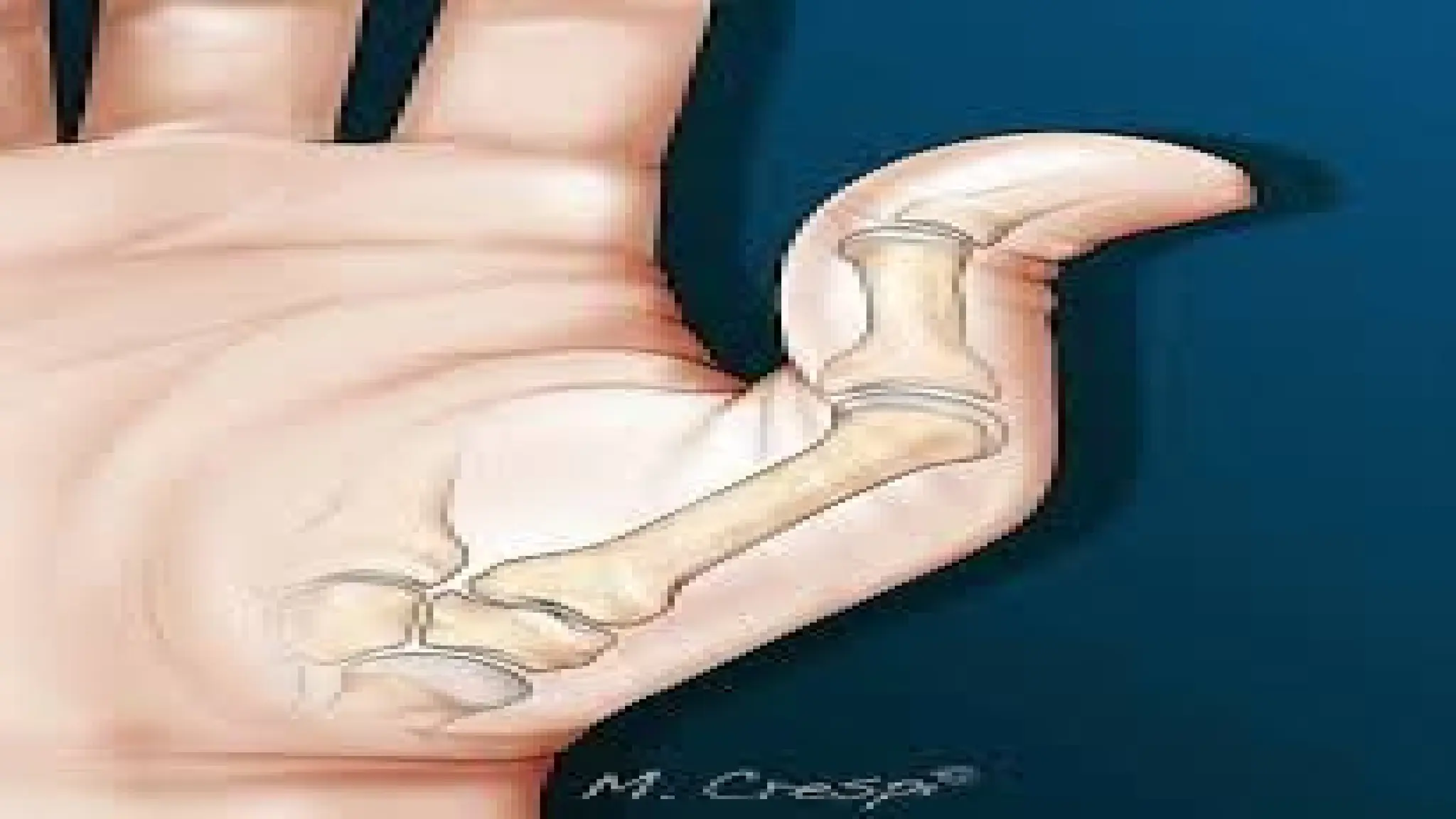 Rheumatoid Arthritis presentation ppt.pptx