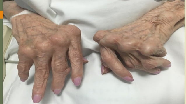 Rheumatoid Arthritis Presentation Managementpptx 0594