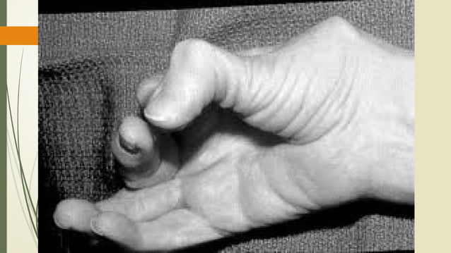 Rheumatoid Arthritis Presentation Managementpptx 1901