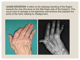 Rheumatoid Arthritis by G.A. Sai manasa.pptx