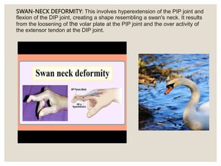 Rheumatoid Arthritis by G.A. Sai manasa.pptx