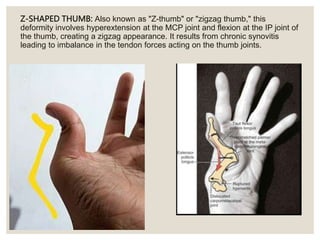 Rheumatoid Arthritis by G.A. Sai manasa.pptx