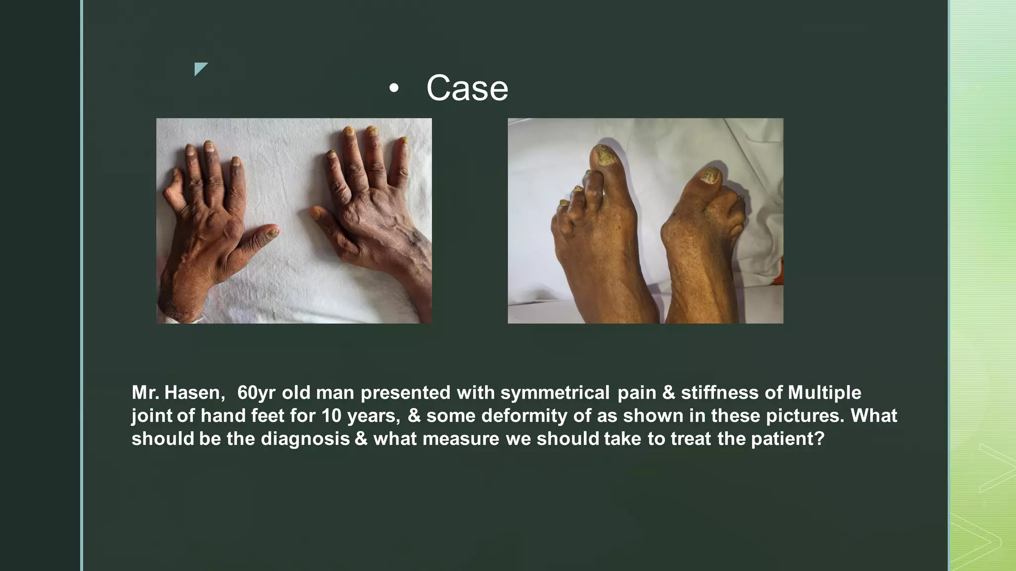 Rheumatoid Arthritis Presentation by Dr Shuvo.pdf