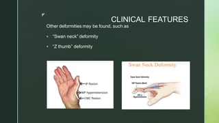 Rheumatoid Arthritis Presentation by Dr Shuvo.pdf