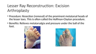 Rheumatoid Forefoot and Complex Reconstruction.pptx
