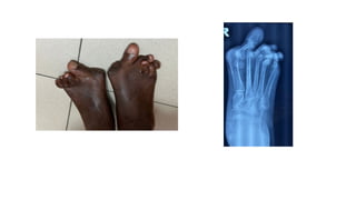 Rheumatoid Forefoot and Complex Reconstruction.pptx