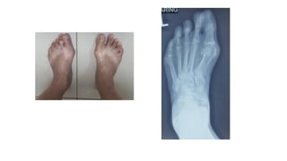 Rheumatoid Forefoot and Complex Reconstruction.pptx