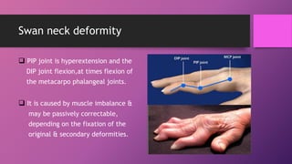 Rheumatoid hand by Dr.Mahbub | PPTX