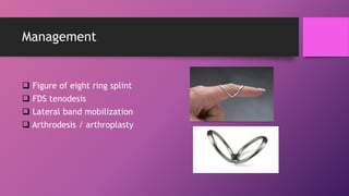 Rheumatoid hand by Dr.Mahbub | PPTX | Death, Injury, or Military ...