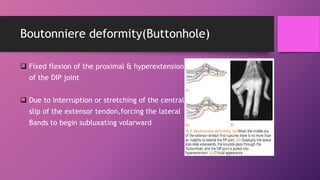 Rheumatoid hand by Dr.Mahbub | PPTX