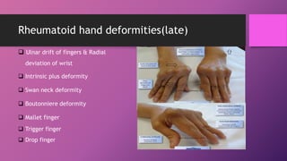 Rheumatoid hand by Dr.Mahbub | PPTX | Death, Injury, or Military ...