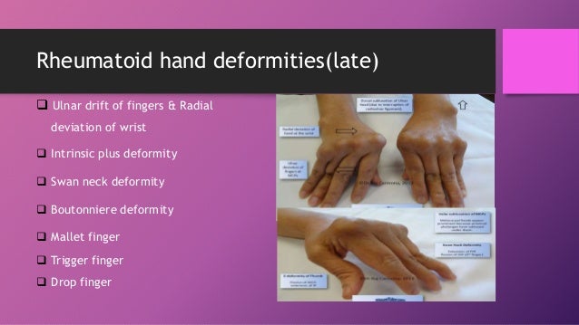 Rheumatoid hand by Dr.Mahbub