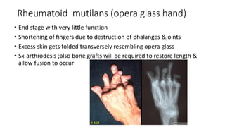 Rheumatoid hand, Orthopaedics Dr Amal jose.pdf