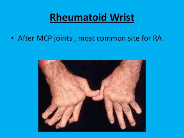 Rheumatoid hands