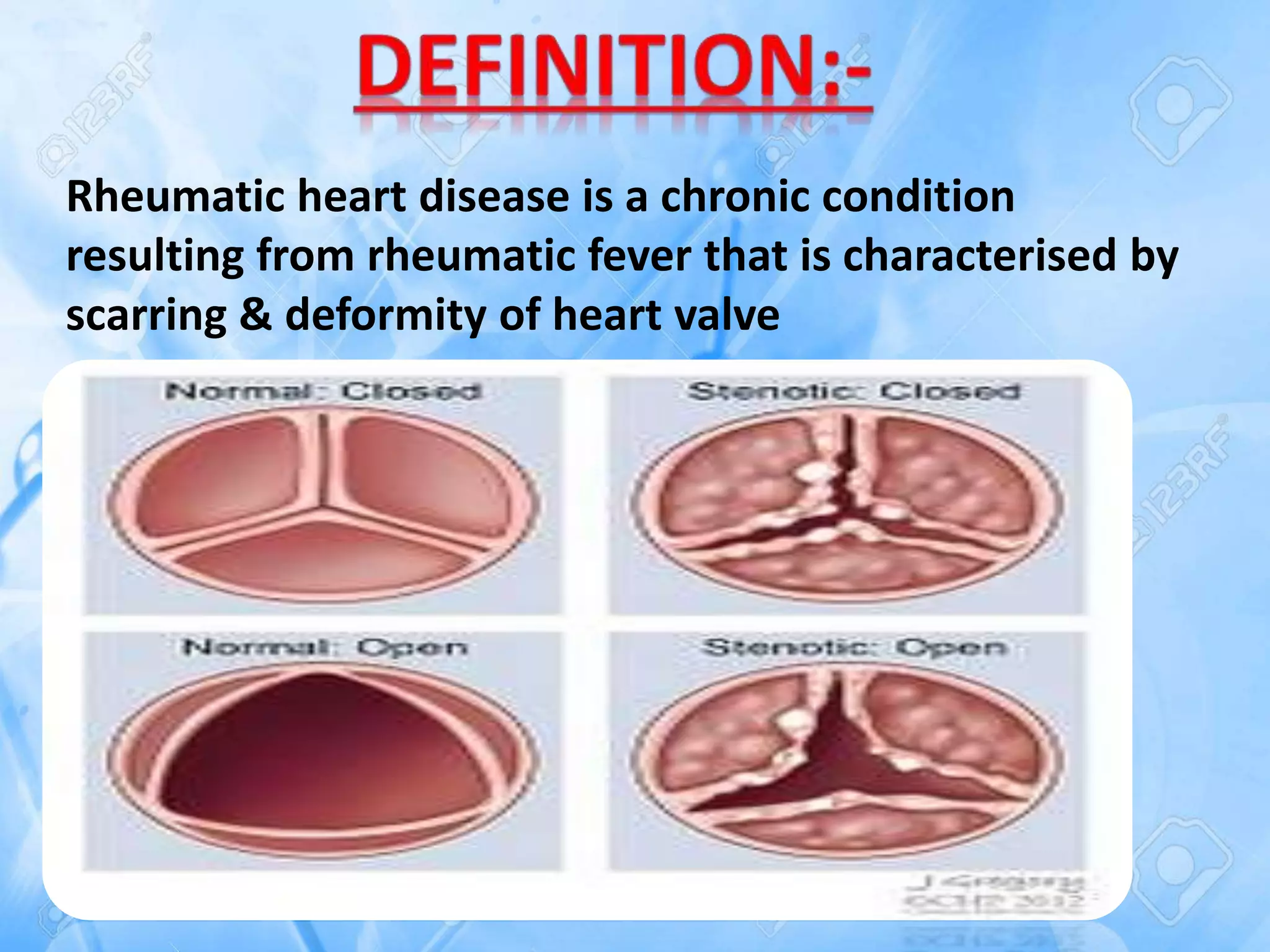 Rheumatoid heart disease | PPT