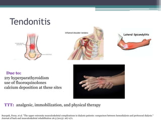 Rheumatological aspects in hemodialysis | PPTX