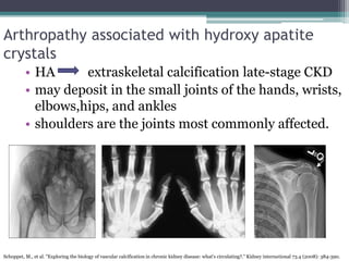 Rheumatological aspects in hemodialysis | PPTX