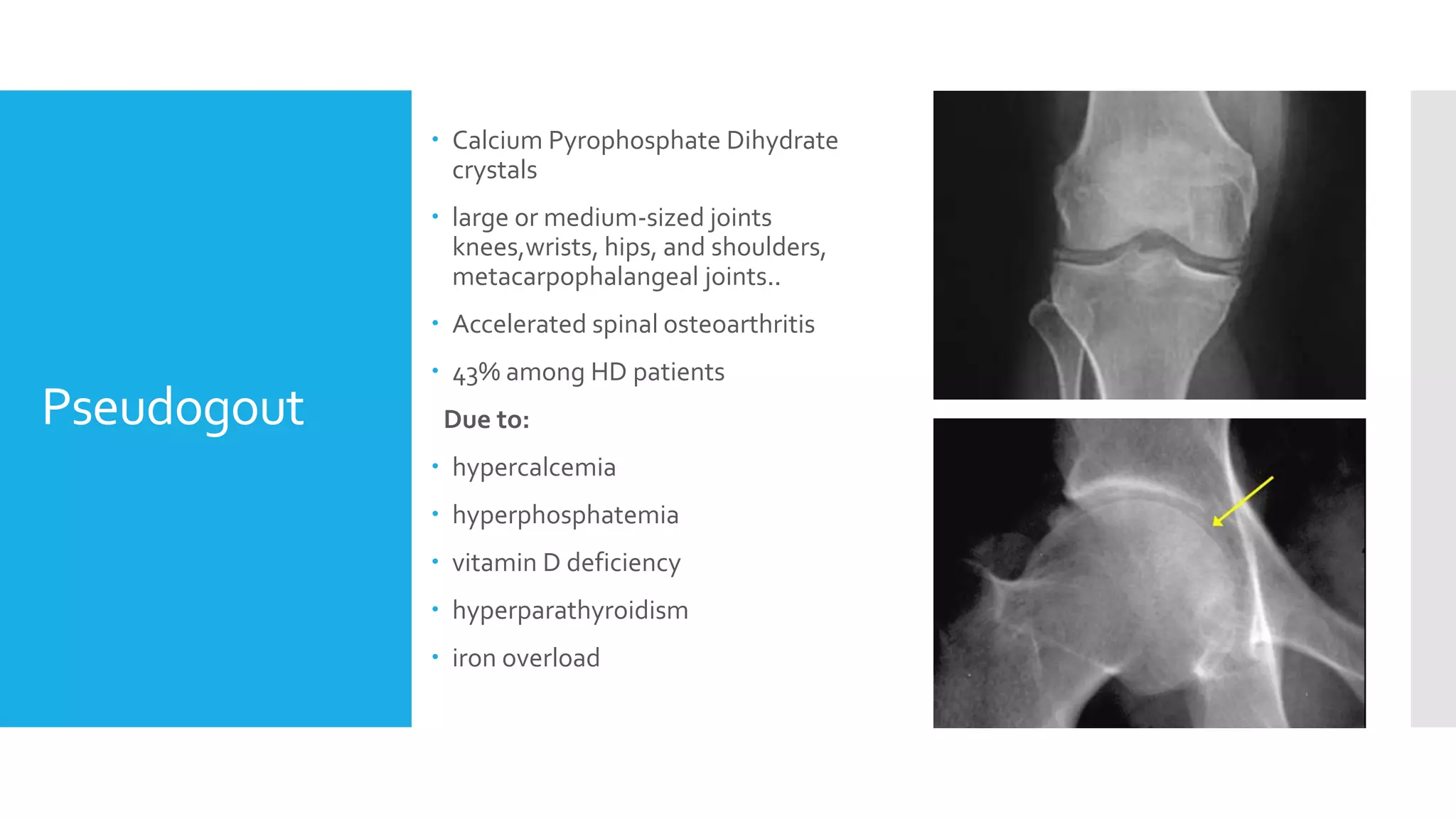 Rheumatological aspects in hemodialysis patients 2019 | PPTX