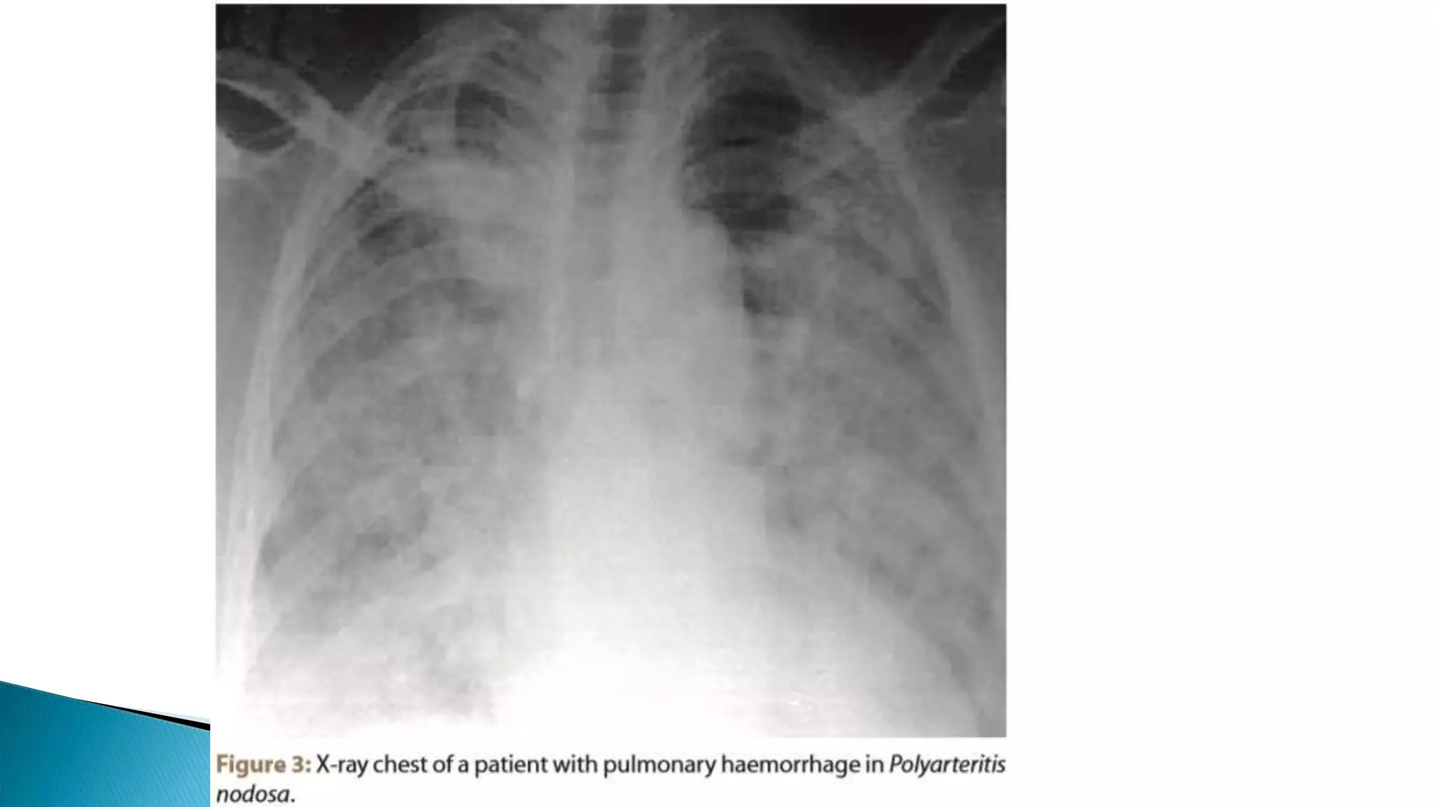 Rheumatological emergencies shivaom | PPTX