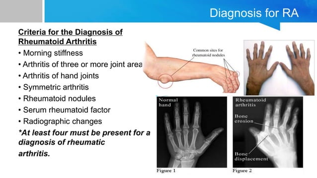 Rheumatologic diseases | PPT