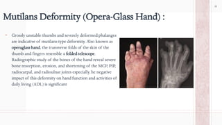 Rheumatology: Understanding Rheumatoid Arthritis & Physiotherapy ...