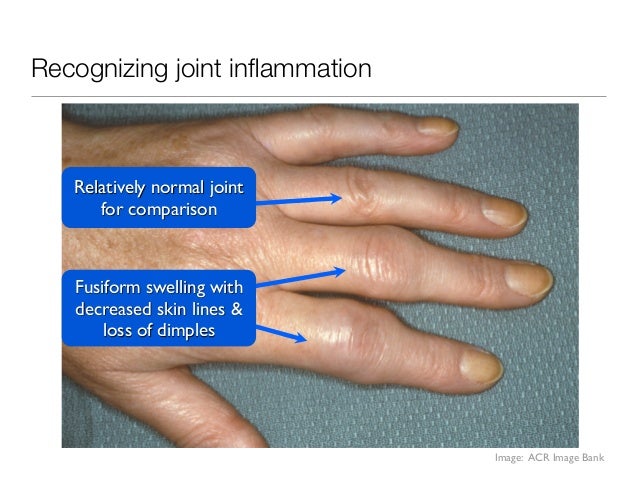 Rheumatology pearls 9-19-2014