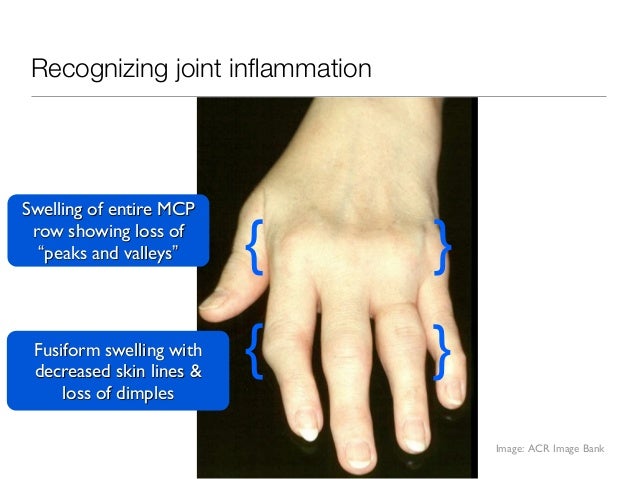 Rheumatology pearls 9-19-2014