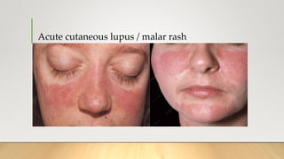 rheumatology revision [Autosaved].pptx