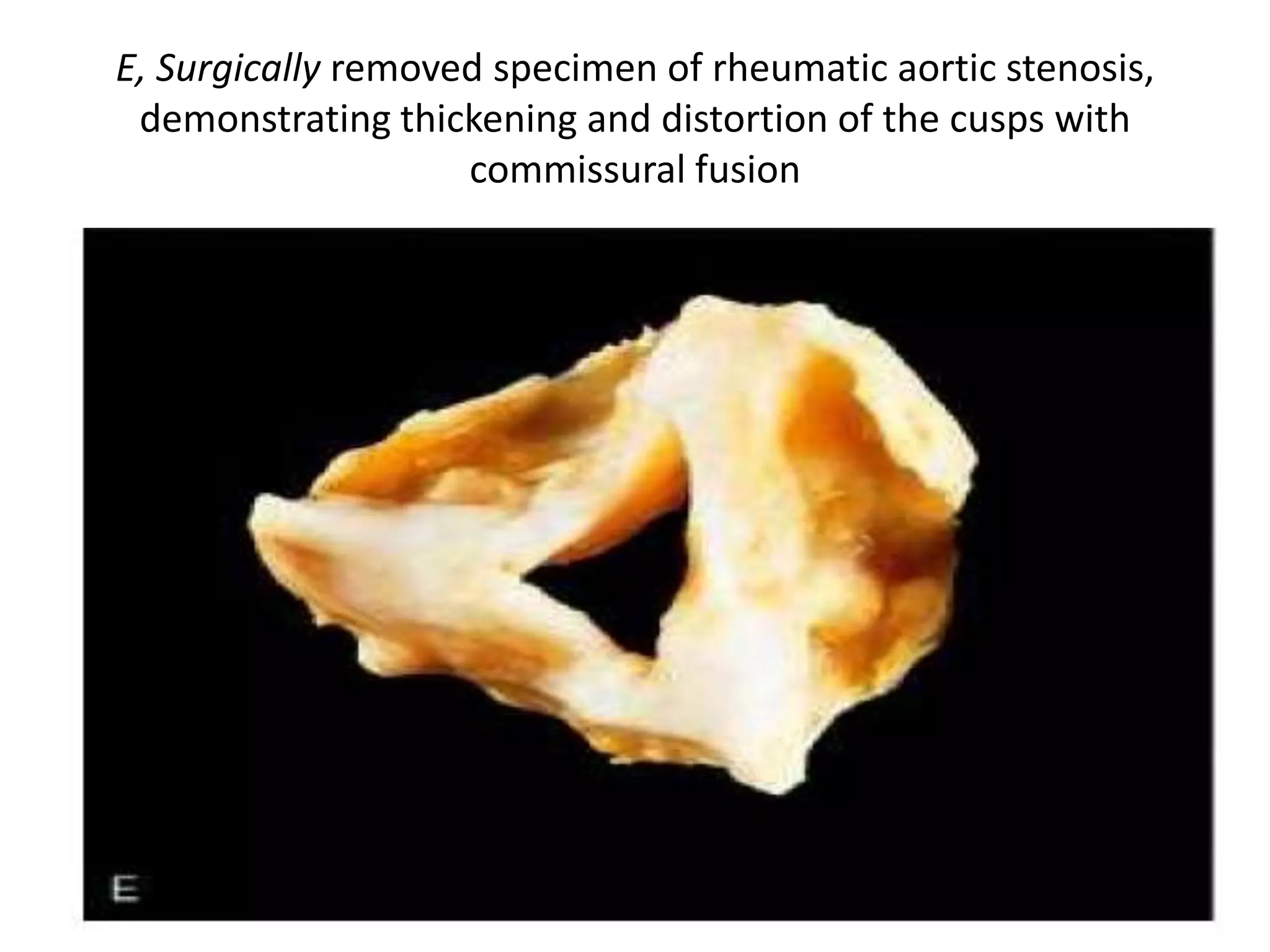 Rheuumatic heart disese | PPTX