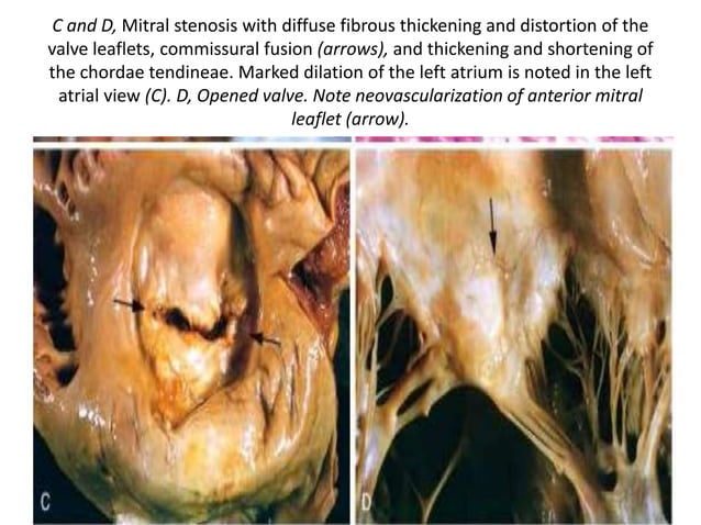 Rheuumatic heart disese | PPT