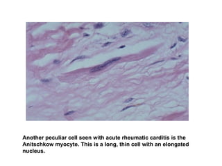 Rheumatic heart disease | PPT