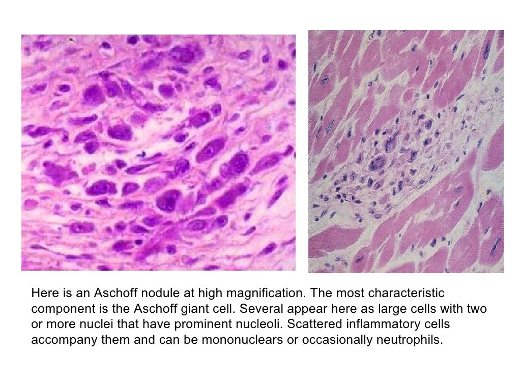 rheumatic-heart-disease