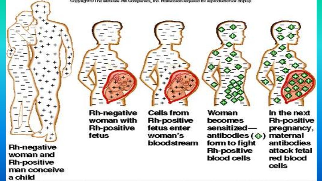 Rh incompatibility