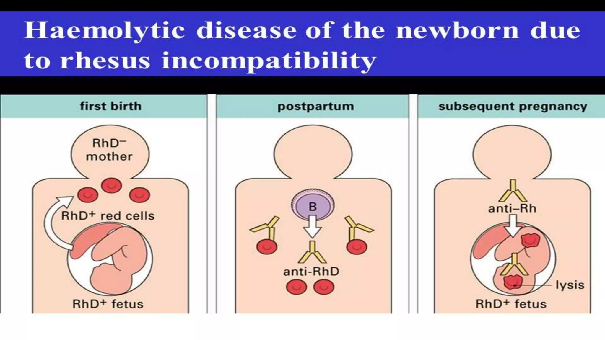 Rh incompatibility | PPTX