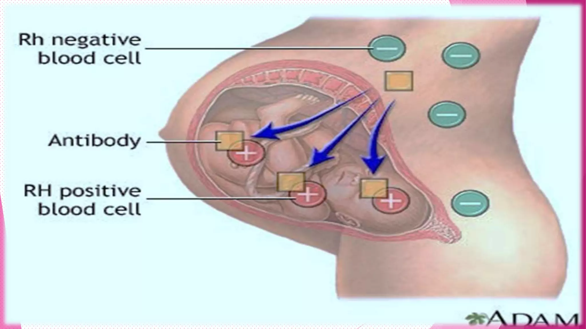 Rh incompatibility | PPTX