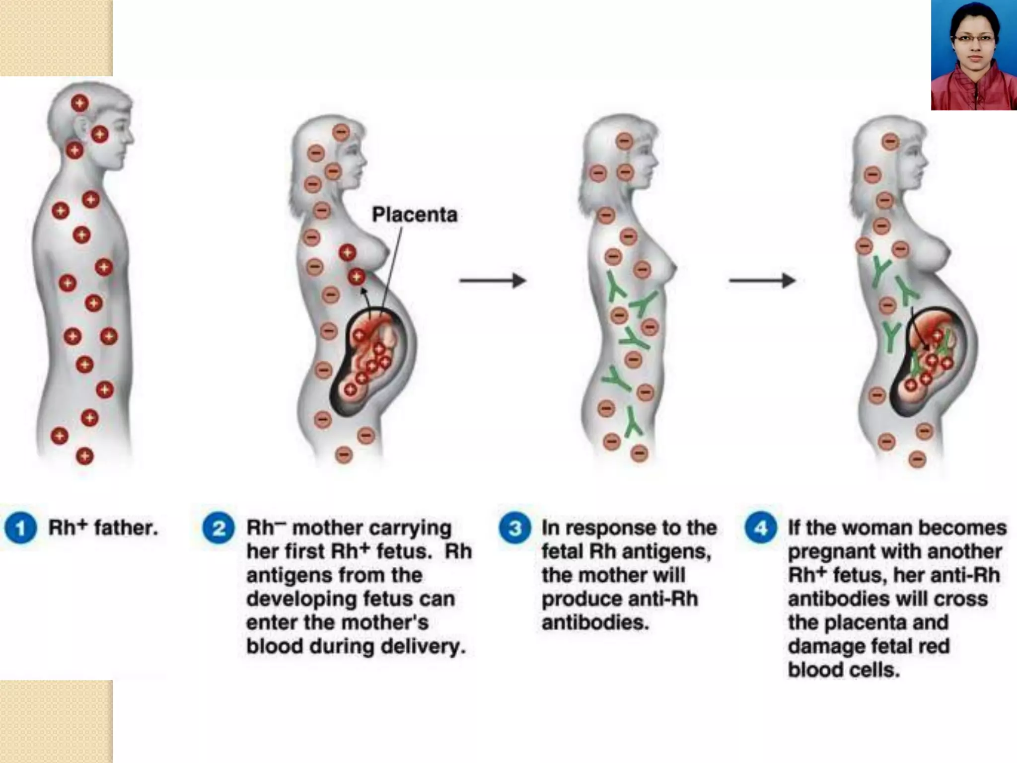 Rh Incompatibility I Hemolytic Disease of the Newborn | PDF