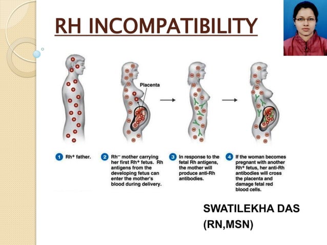 Rh Incompatibility I Hemolytic Disease of the Newborn | PDF | Pregnancy ...