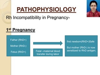 Rh Incompatibility I Hemolytic Disease of the Newborn | PDF