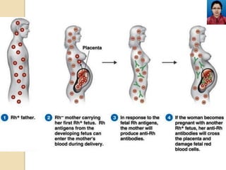 Rh Incompatibility I Hemolytic Disease of the Newborn | PDF