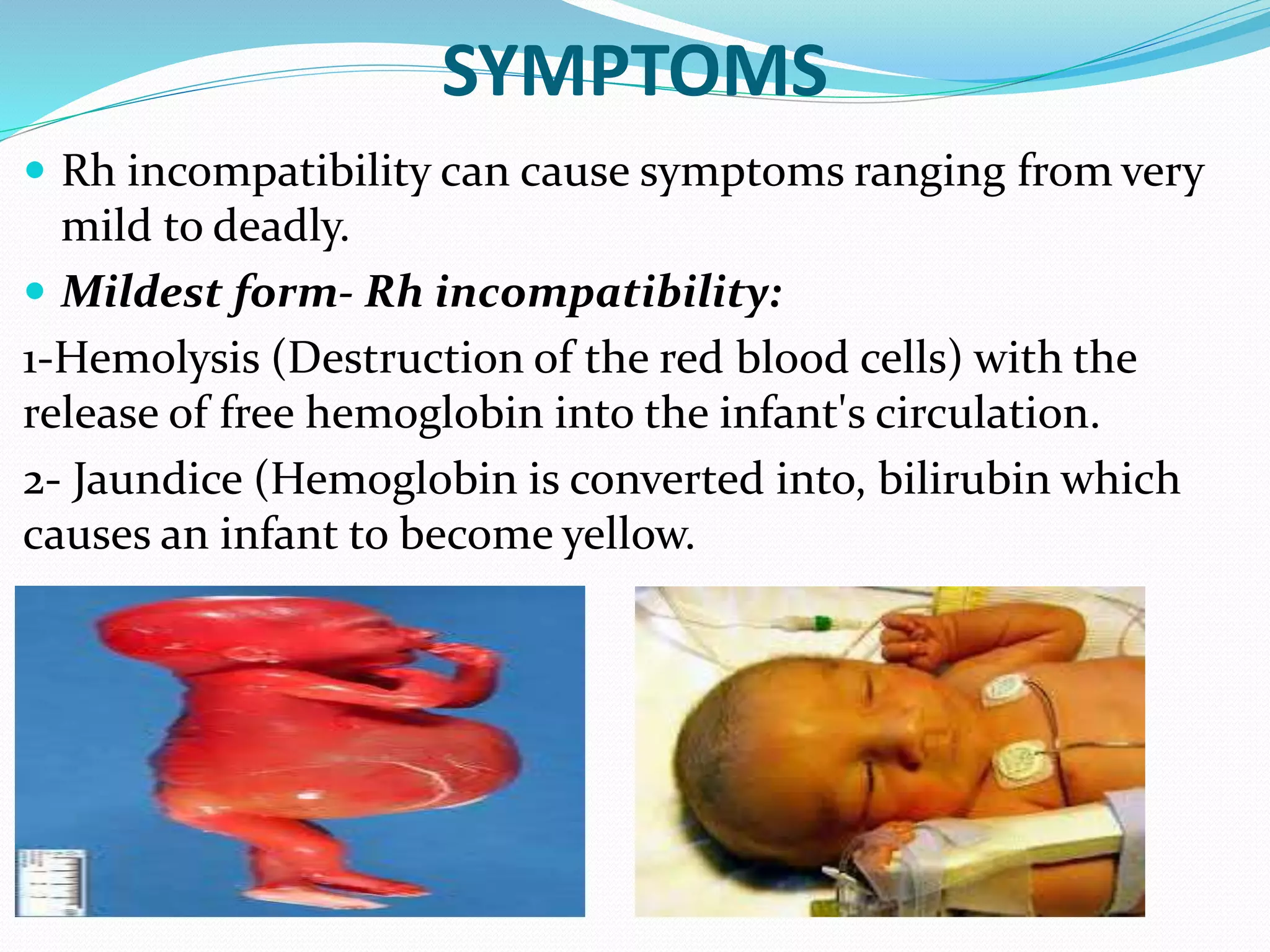 Rh incompatibility | PPTX