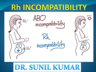 Rh incompatibility | PPTX