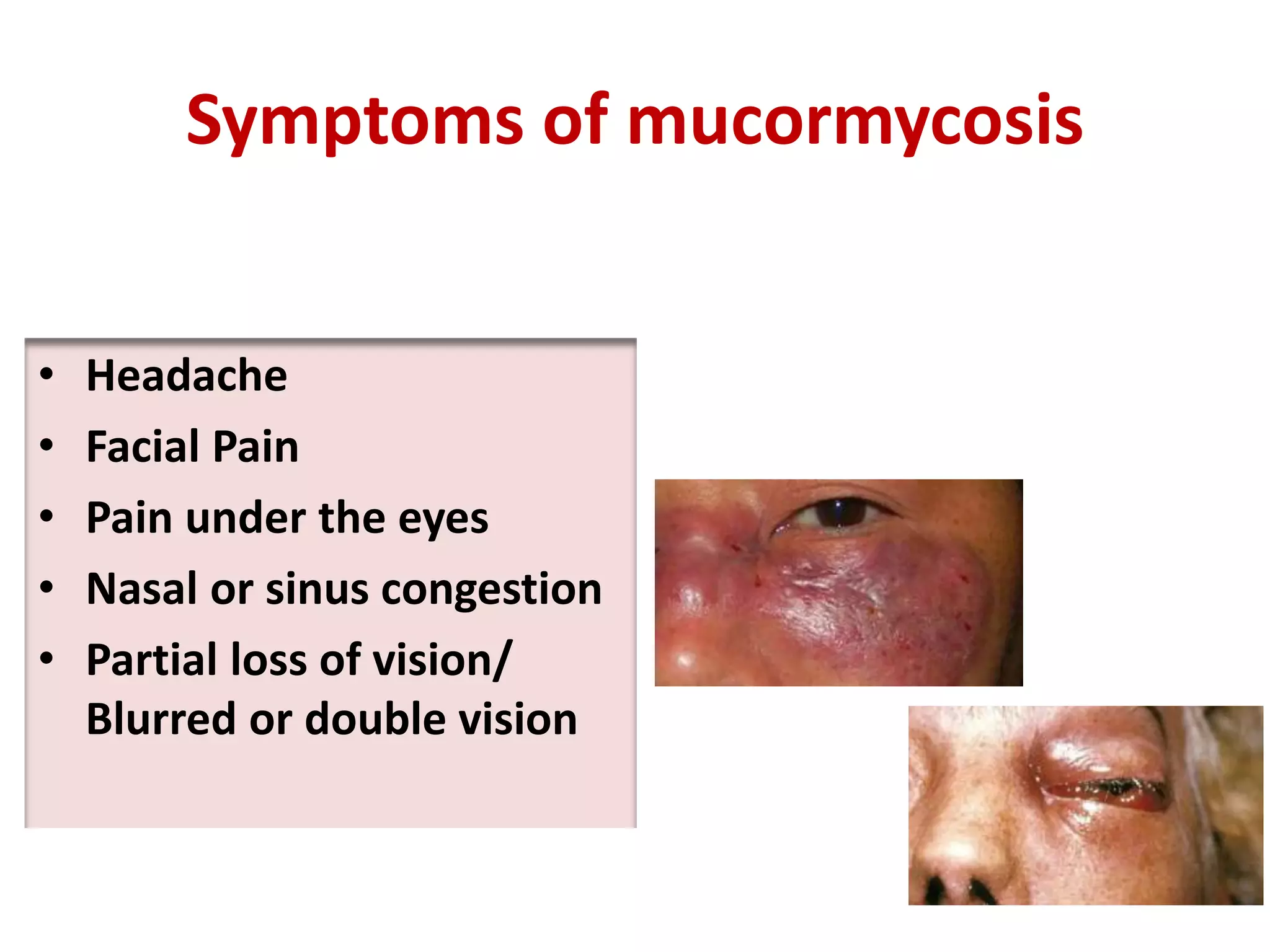Rhini orbito cerebral mucormycosis | PPTX