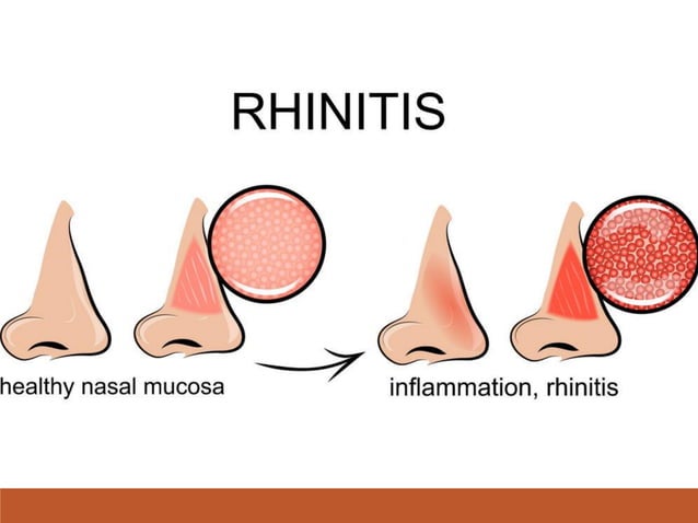 Rhinitis-Medical Surgical Nursing Topic
