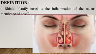 rhinitis.pdf