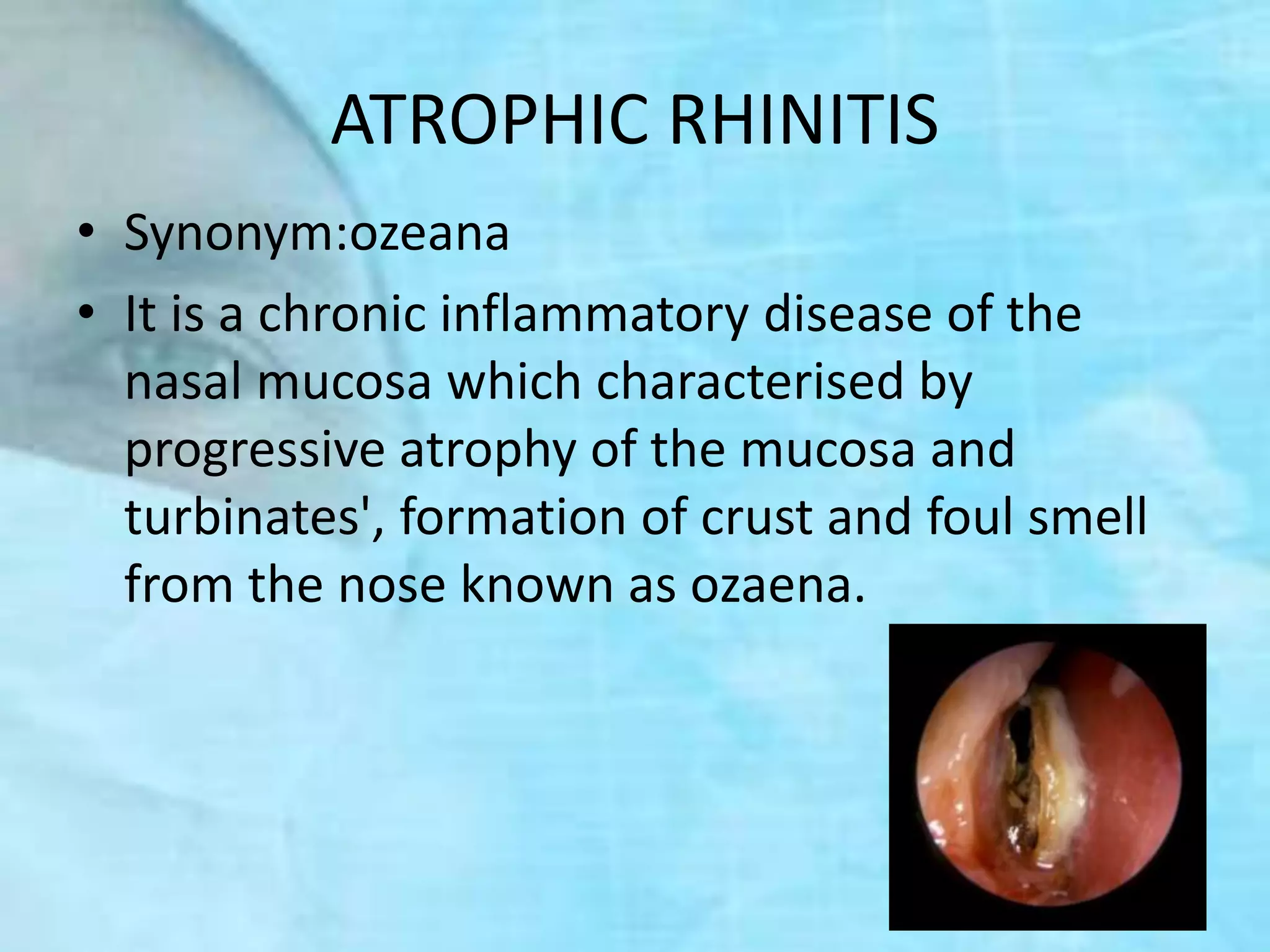 Rhinitis | PPTX